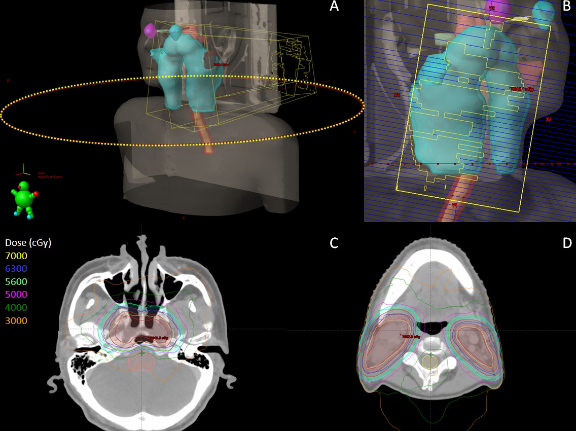 (弧形強度調控放射線治療（RapidArc） ) 臺中榮總全球資訊網 Taichung Veterans General Hospital