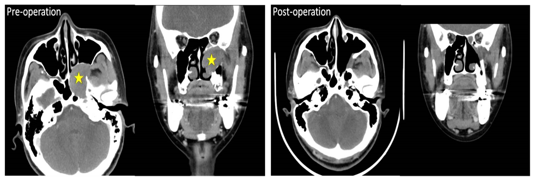Taichung Veterans General Hospital(臺中榮民總醫院) - - (Sinonasal Tumor/ Skull ...